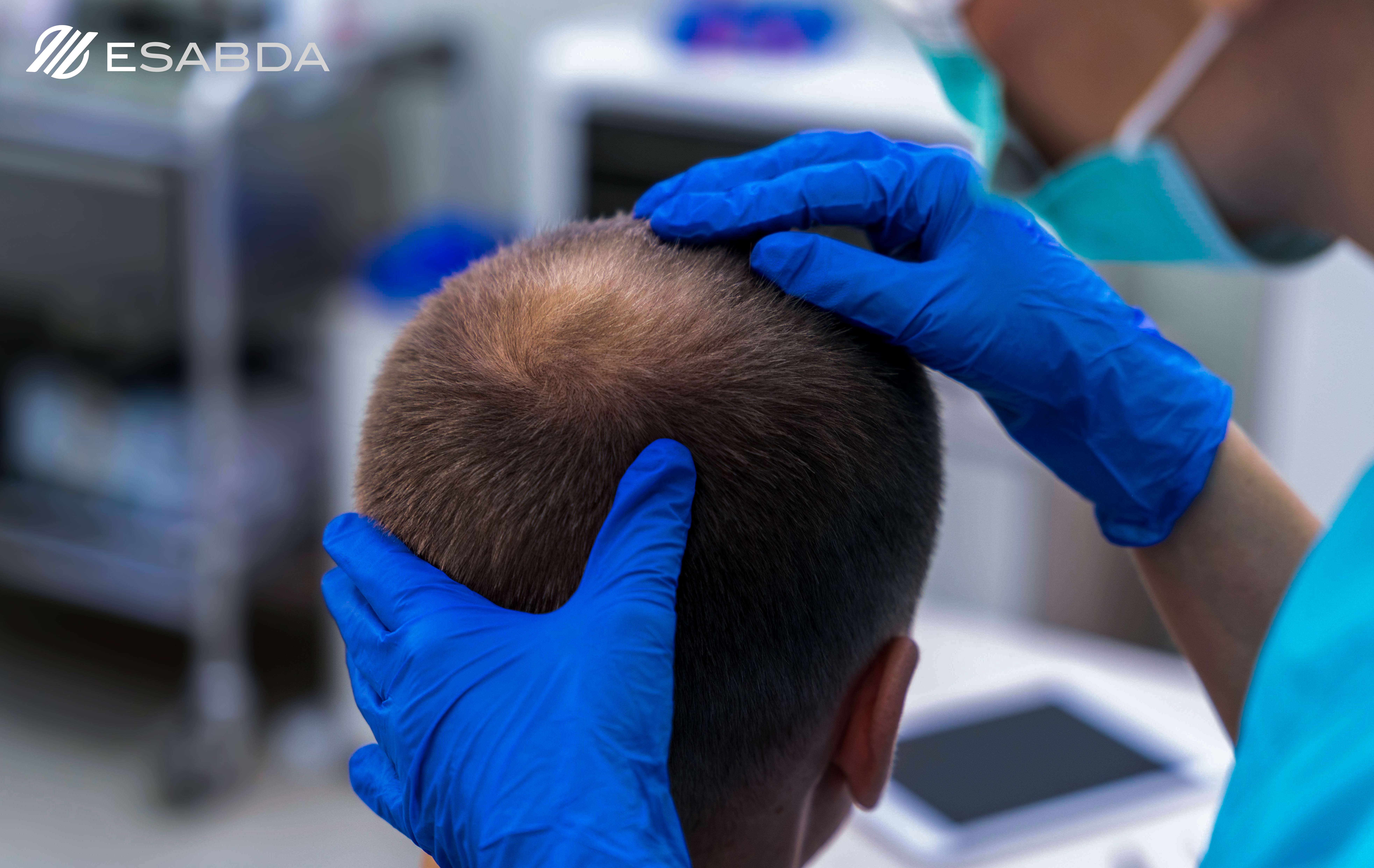 Best Hair Transplant Clinic Hair Transplant Cost In Nepal
